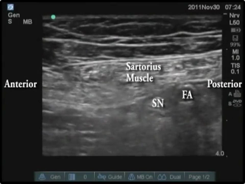 4: Ultrasound-Guided Mid-Thigh Saphenous Nerve Block - BLOCKJOCKS.COM