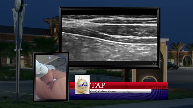 LSORA Quadratus Lumborum Block - TAP, Quadratus Lumborum, & Rectus ...