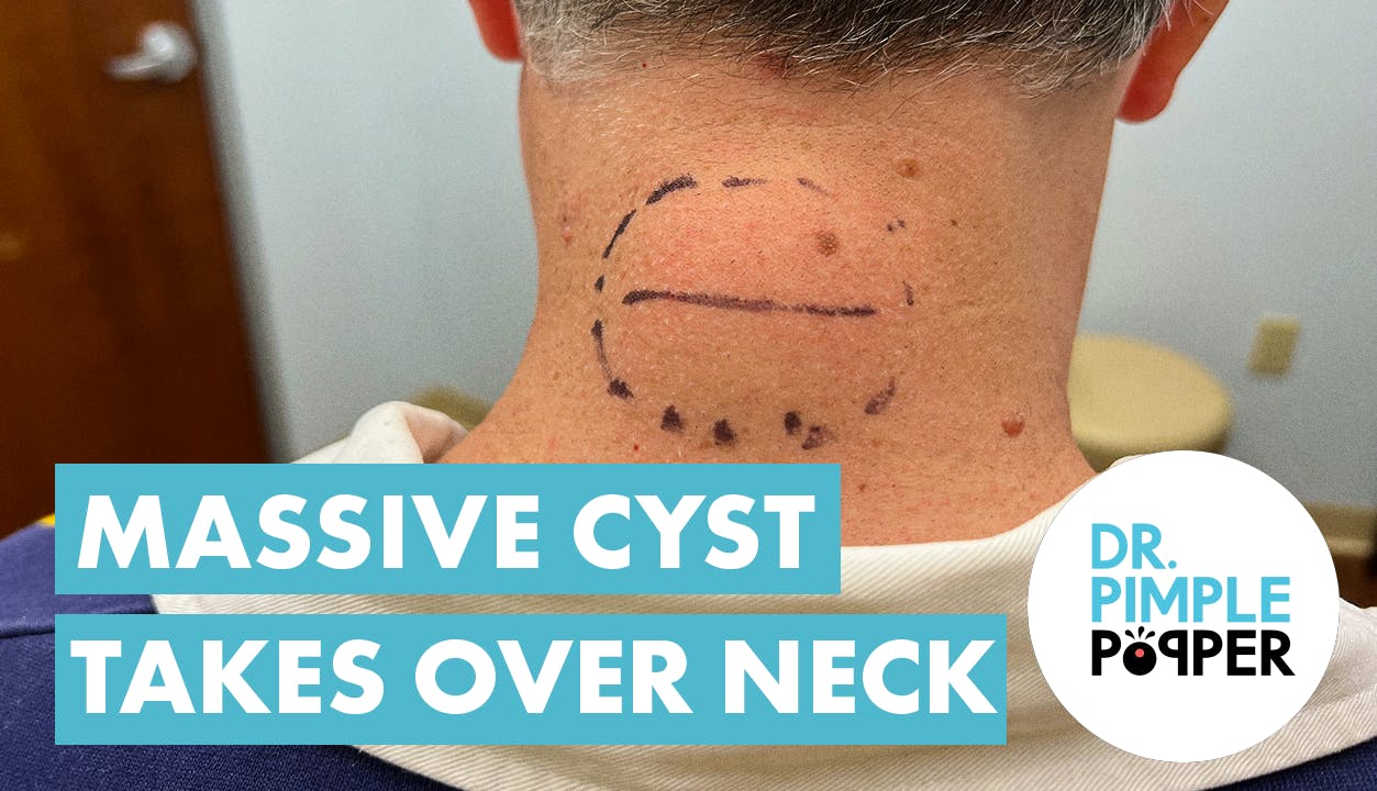 Massive Lipoma Takes Over Neck Dr Pimple Popper Saves The Day Cystactular Cysts Dr Pimple