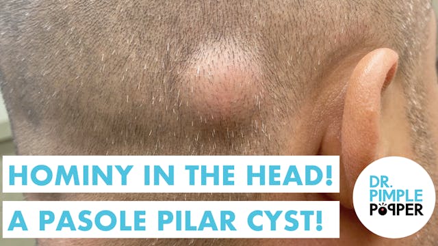 A Very Hairy Removal On This Scalp Cyst Cystactular Cysts Dr Pimple Popper