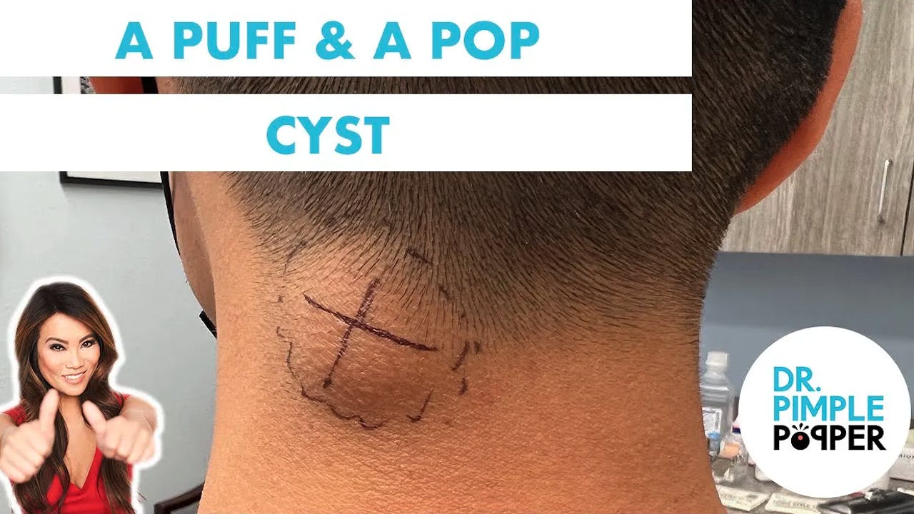 A Puff And A Pop Cyst Dr Pimple Popper