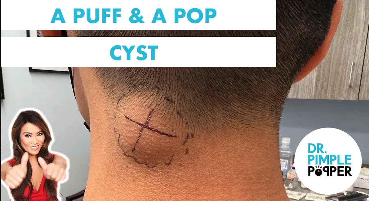 A Puff And A Pop Cyst Dr Pimple Popper