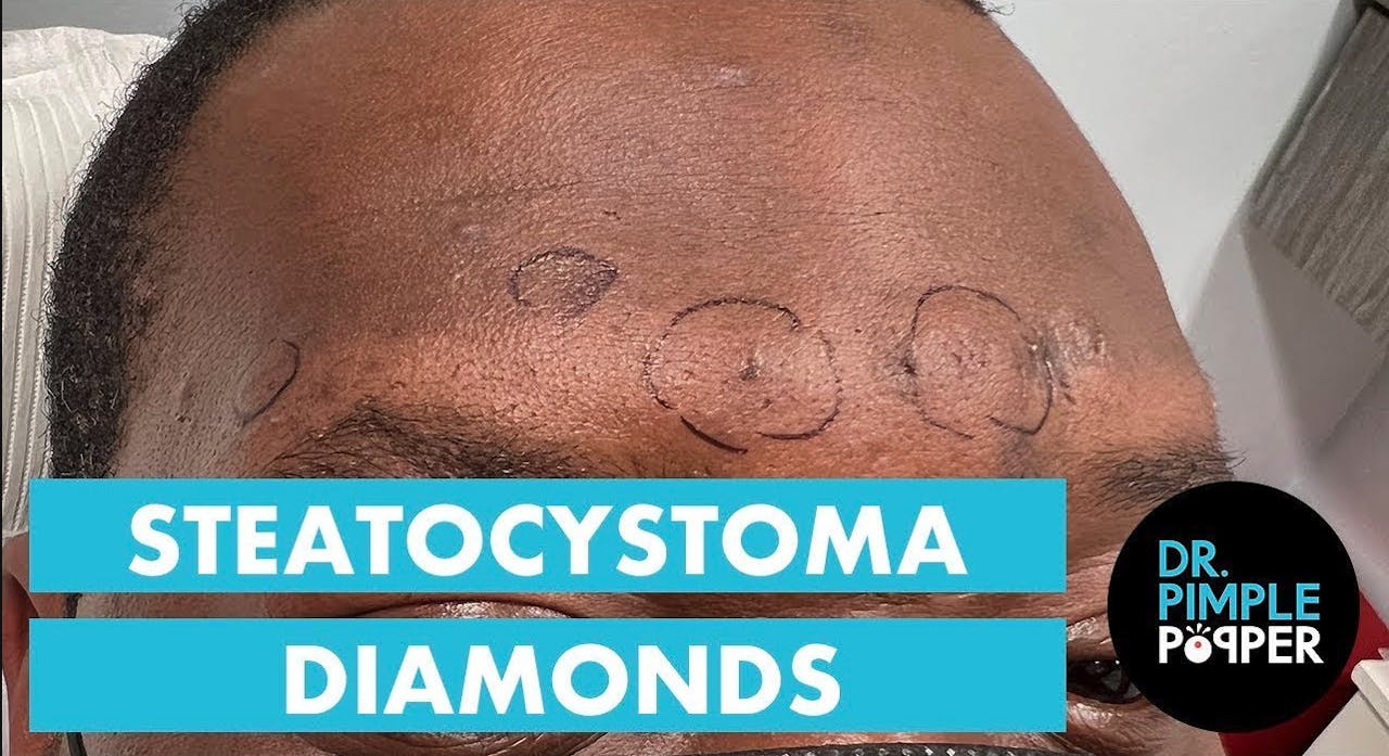 Steatocystoma Diamonds Recently Added Dr Pimple Popper