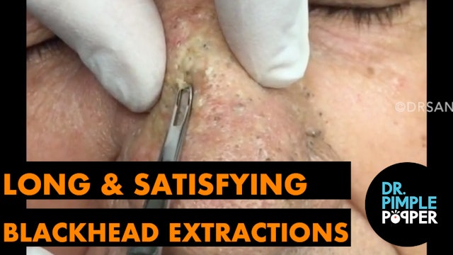 Bedtime Blackheads Dr Pimple Popper