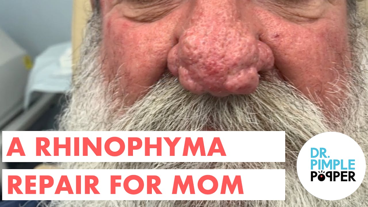 Rhinophyma Repair Dedicated To Mom Recently Added Dr Pimple Popper