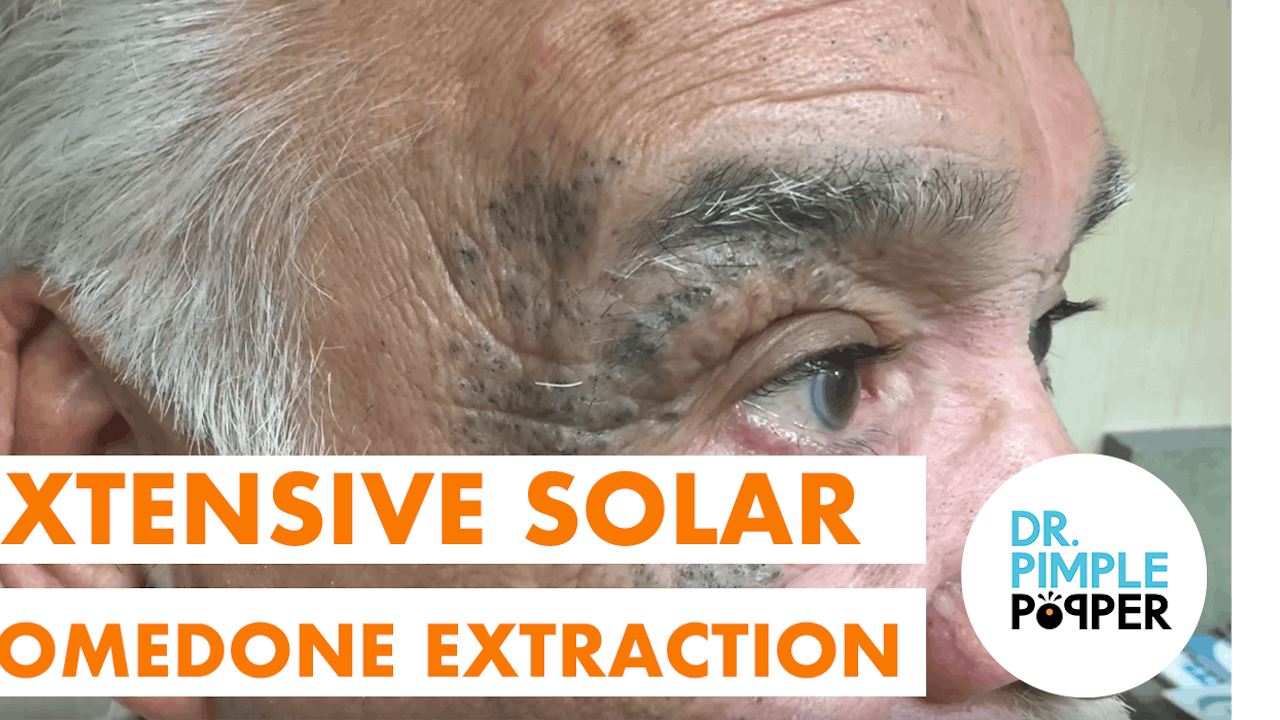 Extensive Solar Comedone Extraction Masked Man Part 1 Blackheads And Whiteheads Galore Dr