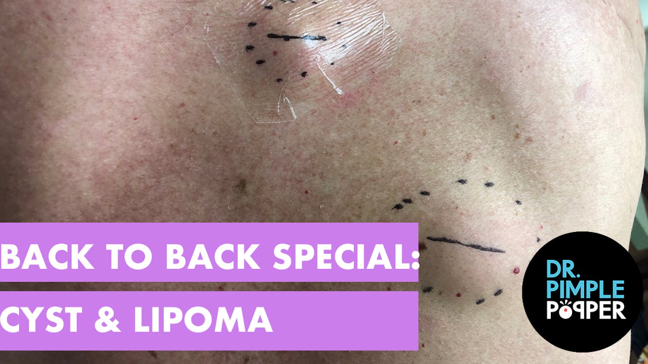 Back To Back Special Lipoma And Cyst Oozy Offerings Dr Pimple Popper