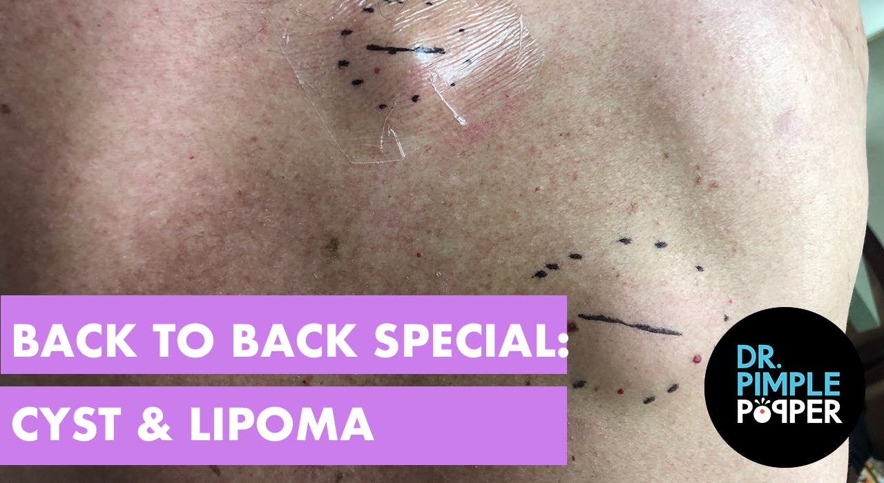 Back To Back Special Lipoma And Cyst Oozy Offerings Dr Pimple Popper
