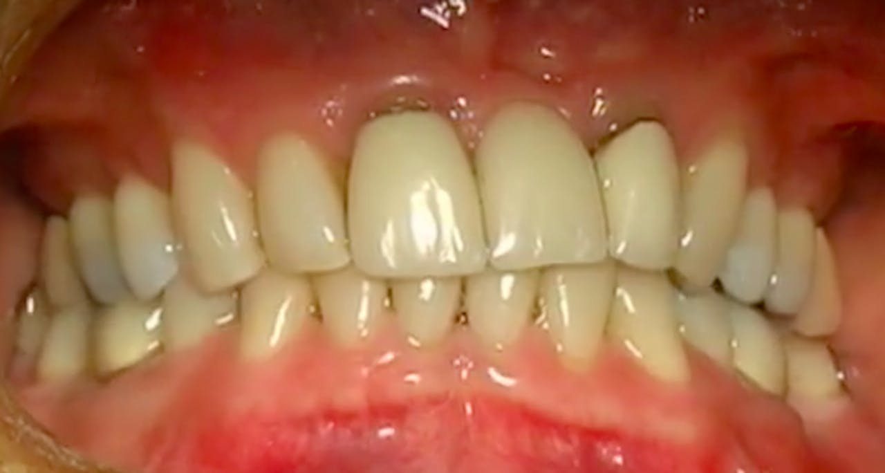 CLINICAL VIDEO Mandibular molar replacement using a flapless approach ...
