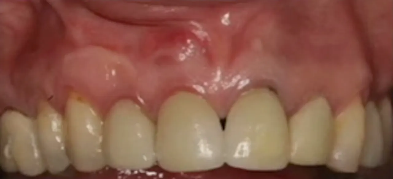 CLINICAL VIDEO Solving a Thin Gingival Biotype in the Upper Anterior ...
