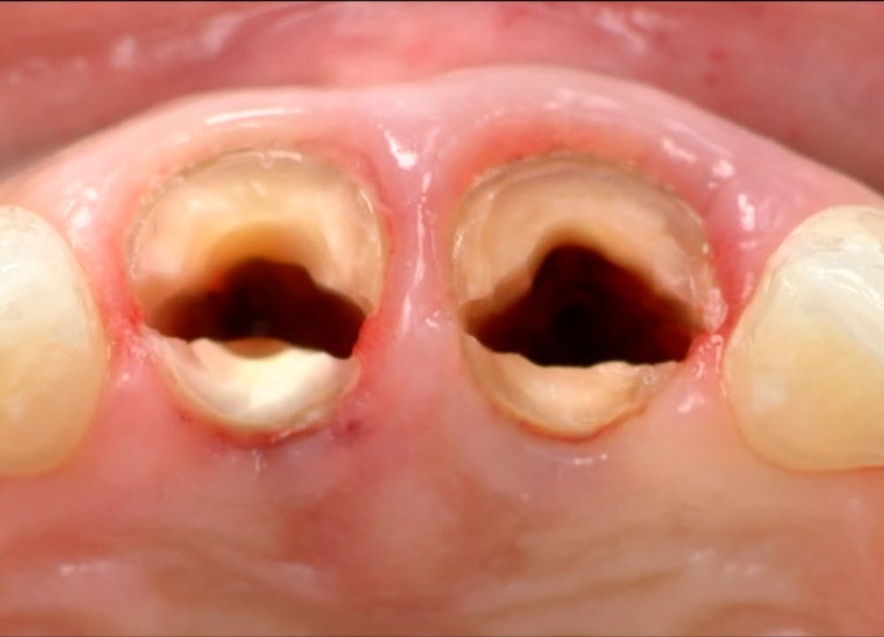 CLINICAL VIDEO The socket-shield technique for 2 anterior immediate ...