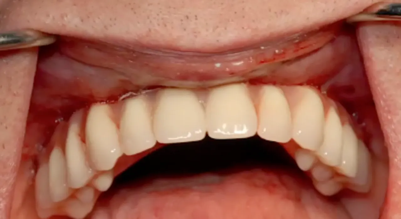 A-Z in Restorative Implant Dentistry (Case 2) - Maxillary Full Arch PFM ...