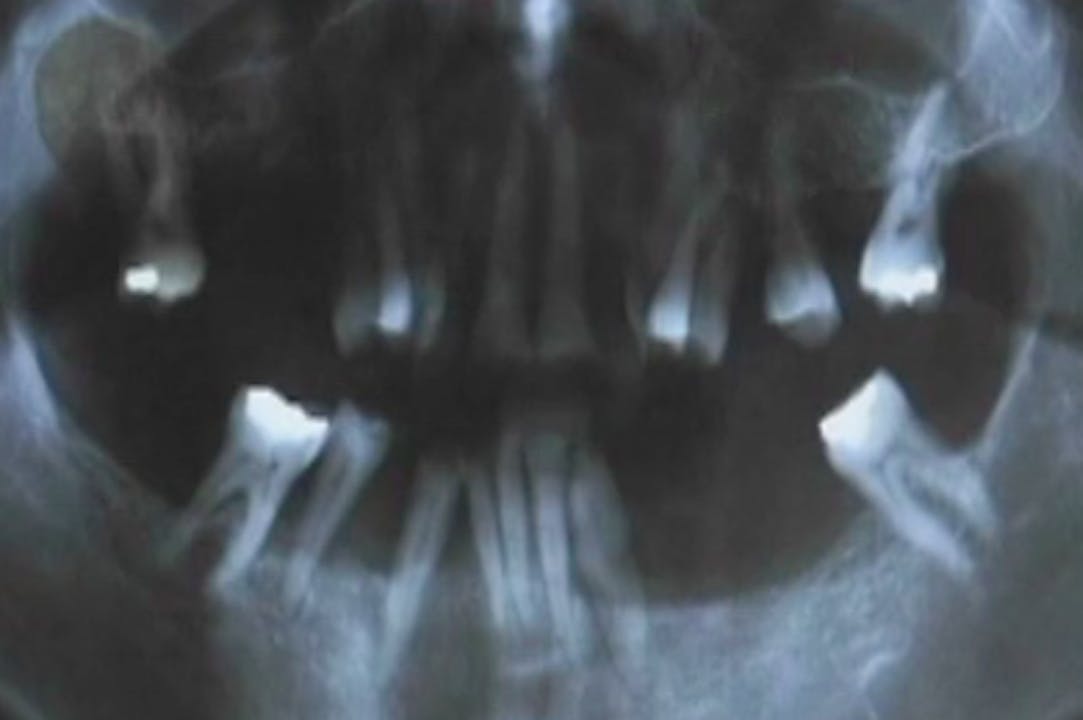 CLINICAL VIDEO Soft Tissue Management During Maxillary Implant ...