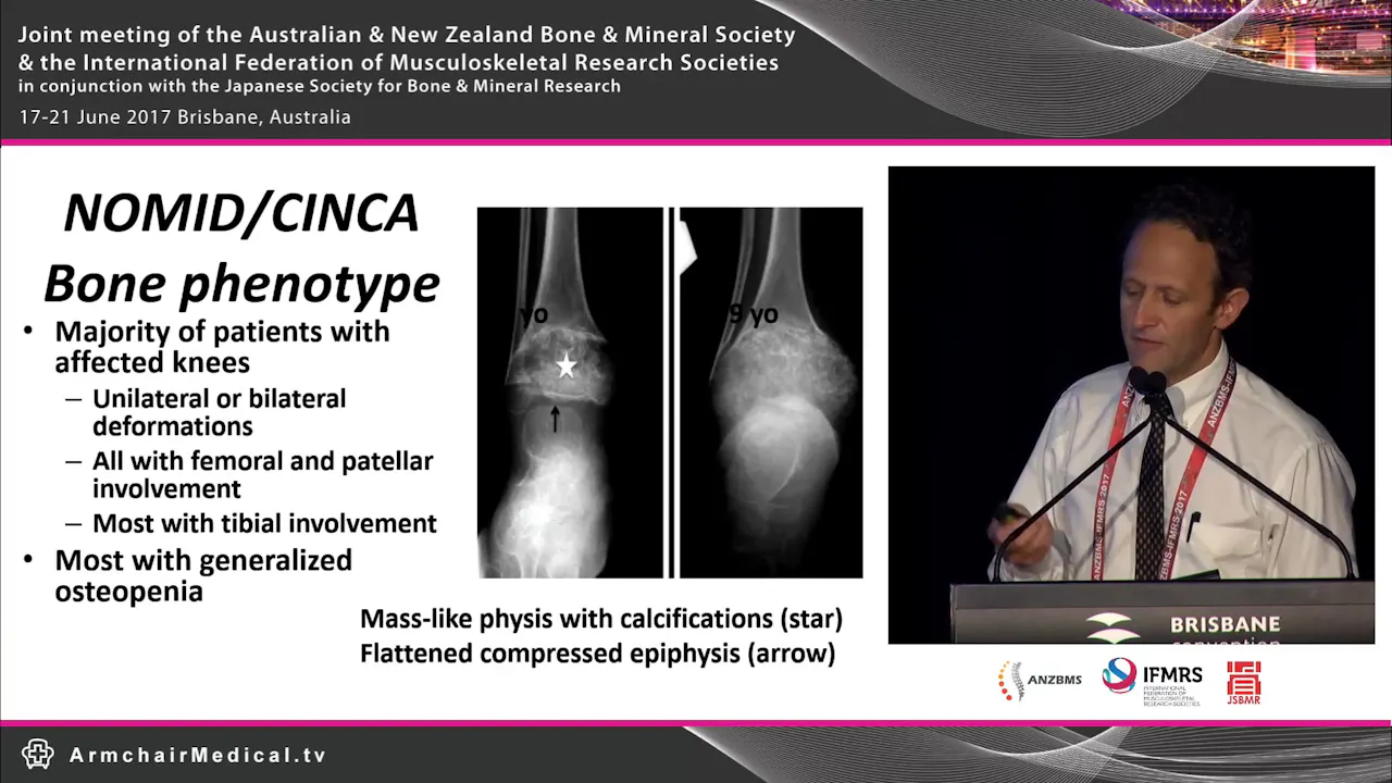 Mechanisms of inflammation and bone disease in CAPS Prof Hal Hoffman ...