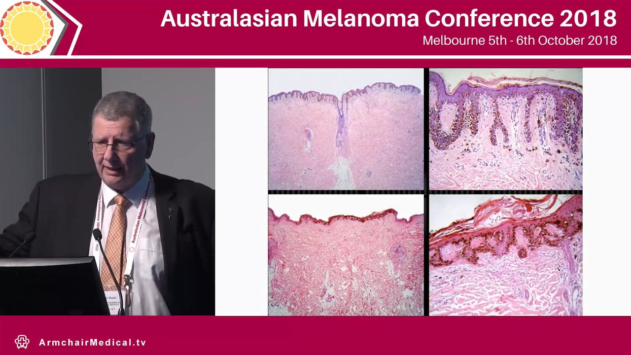 Dermoscopic Subtypes of benign naevi and their significance Peter Soyer ...