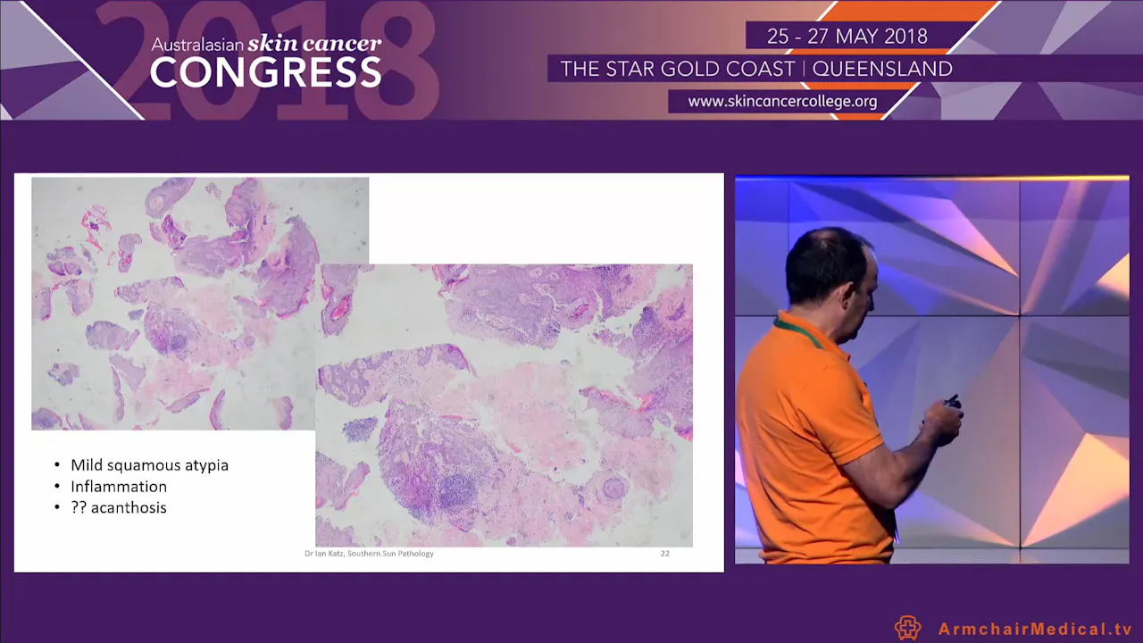 Choosing the most appropriate skin cancer pathology specimen Dr Ian ...