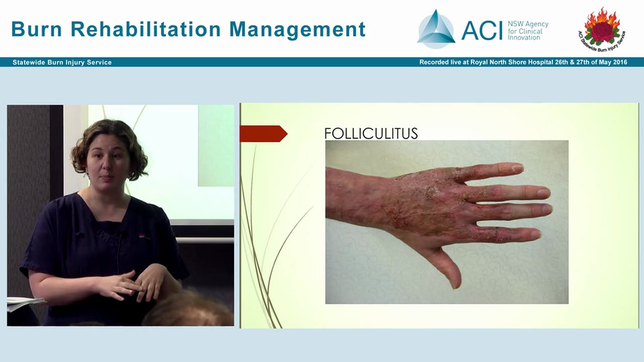 Burn Wound Management in Rehabilitation setting Kate Welsh ...