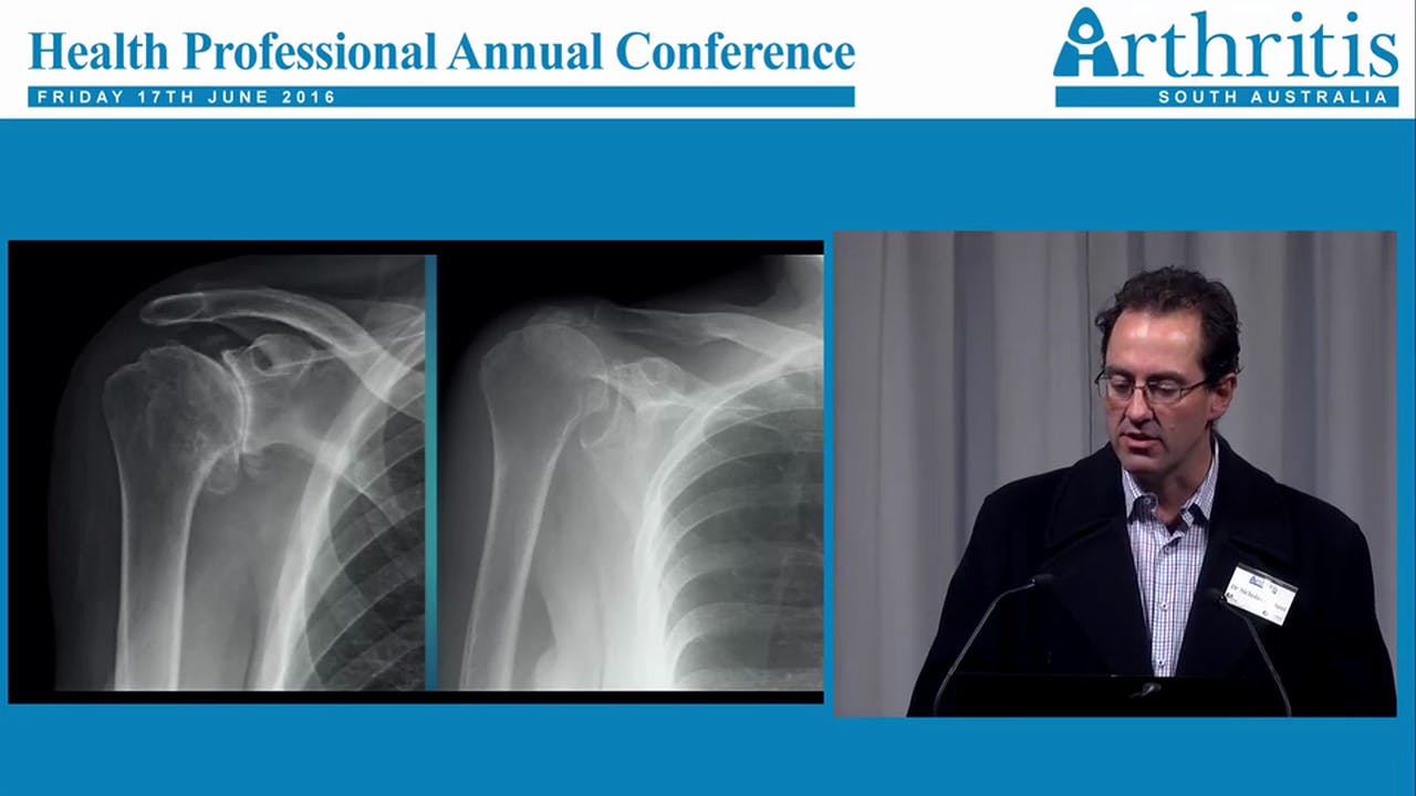 Shoulder Arthritis Surgical Perspective Nicholas Chabrel Orthopaedic ...