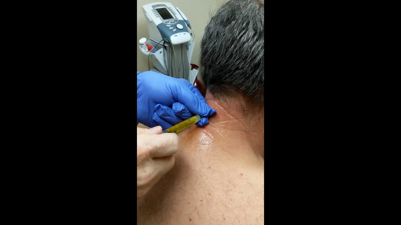 Neck Injection, BA - OCBM Roadmap Virtual Video Training Library