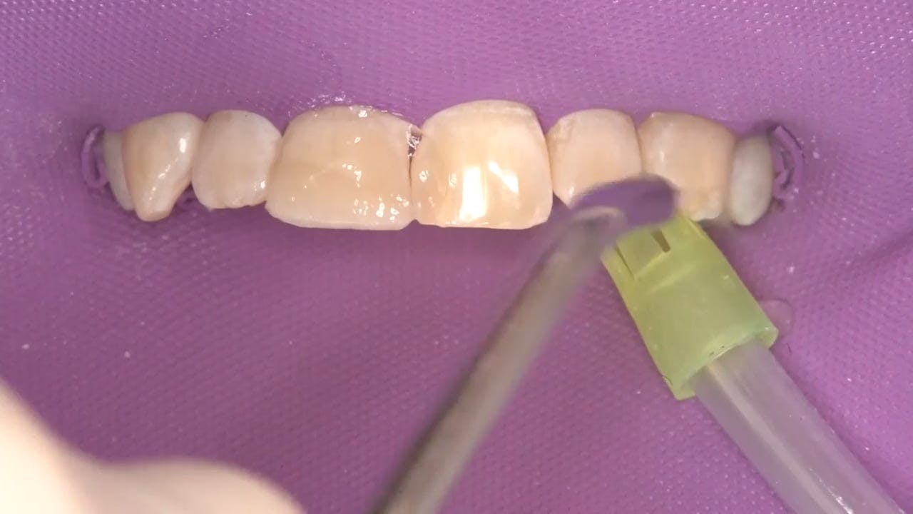 Clinical Case • Class IV tooth 11 - Theoretical of stratification, how ...