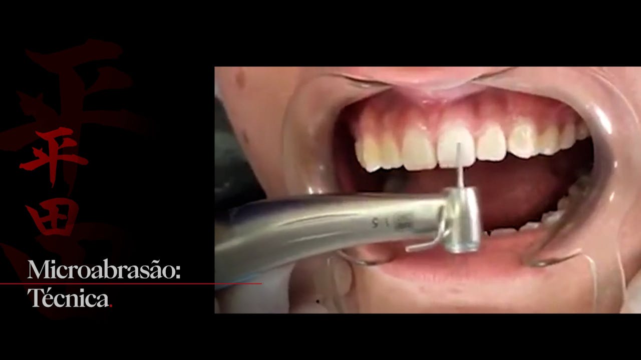 Microabrasion: Technique and Practical Applications - Recipes Book ...