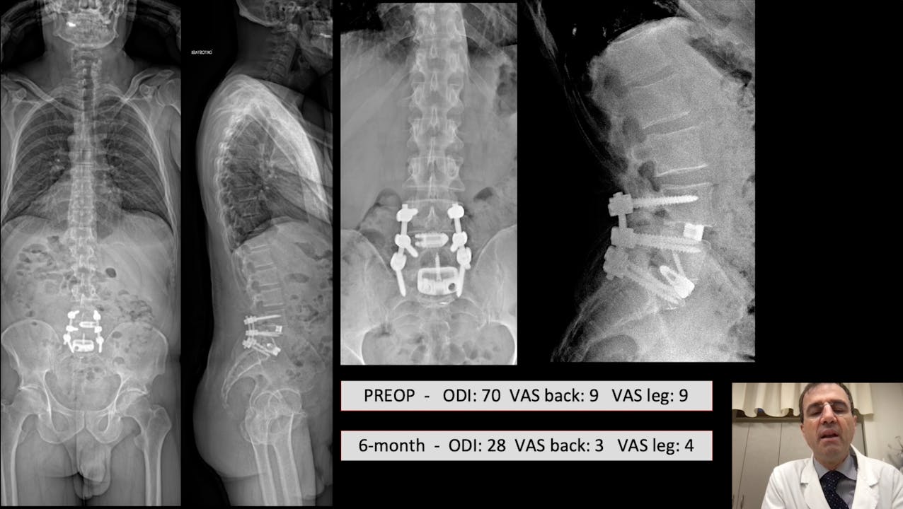 Surgical technique: How to get proper lordosis at L4-L5-S1 - Berjano ...