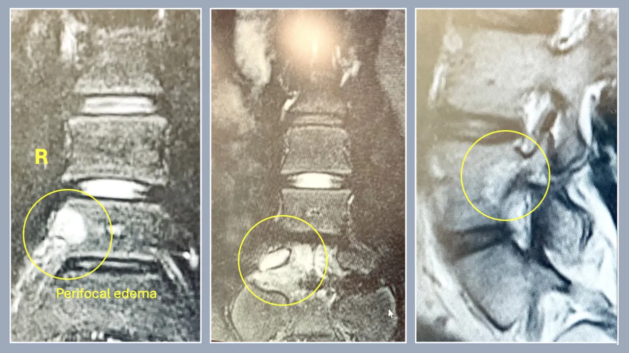Osteoid Osteoma of the L5 Vertebra (Interarticular portion on the right ...
