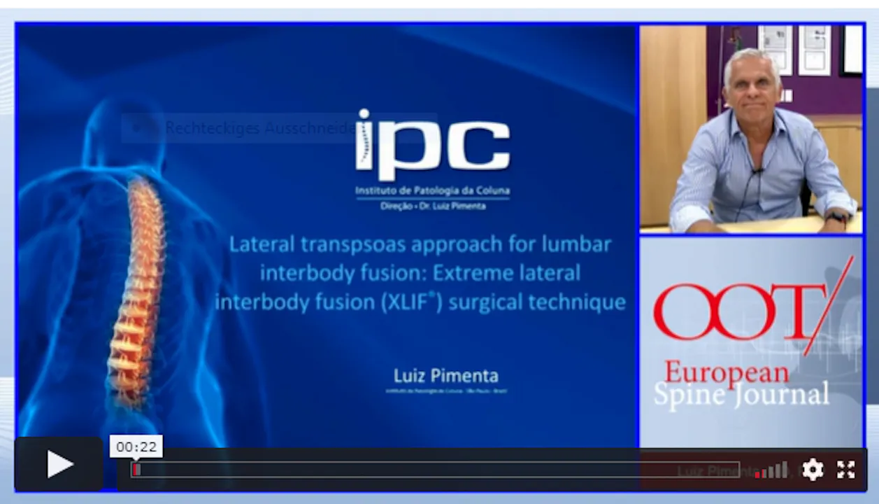 Lateral transpsoas approaqch for lumbar interbody fusion - Pimenta Luiz ...