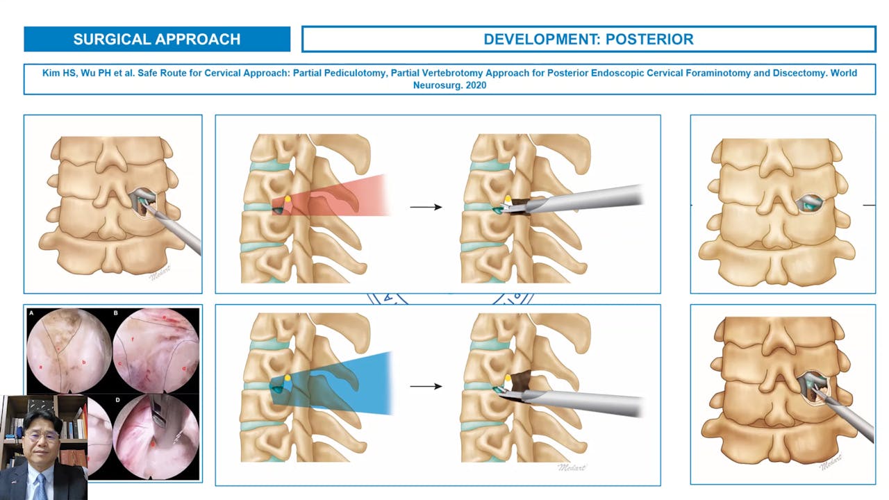 Anatomical consideration of posterior endoscopic cervical foraminotomy ...