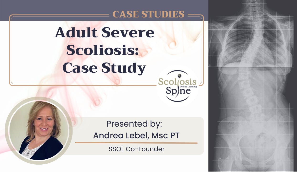 Adult Severe Scoliosis: Case Study - SSOL-GLOBAL